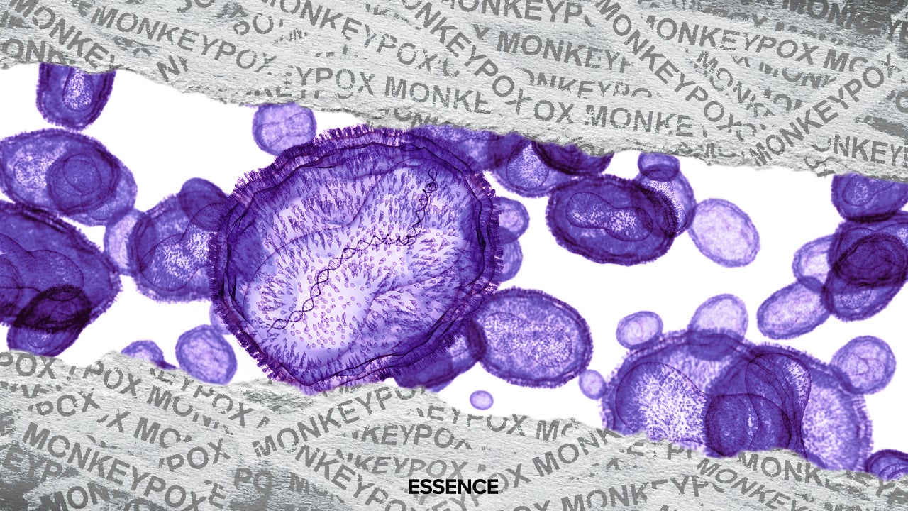 What Is Monkeypox? A Breakdown Of The Virus and Symptoms | Essence